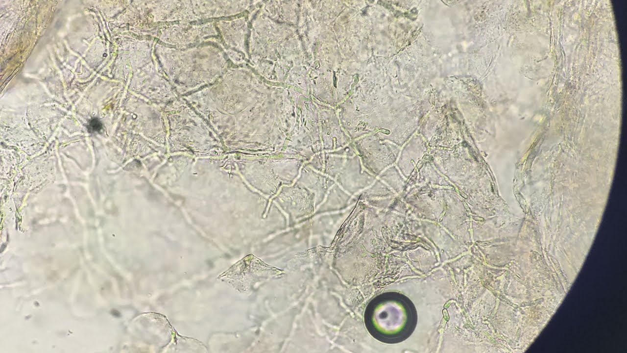 Fungal Infection KOH Test #checkup #medical #microscope #fungi #candida ...
