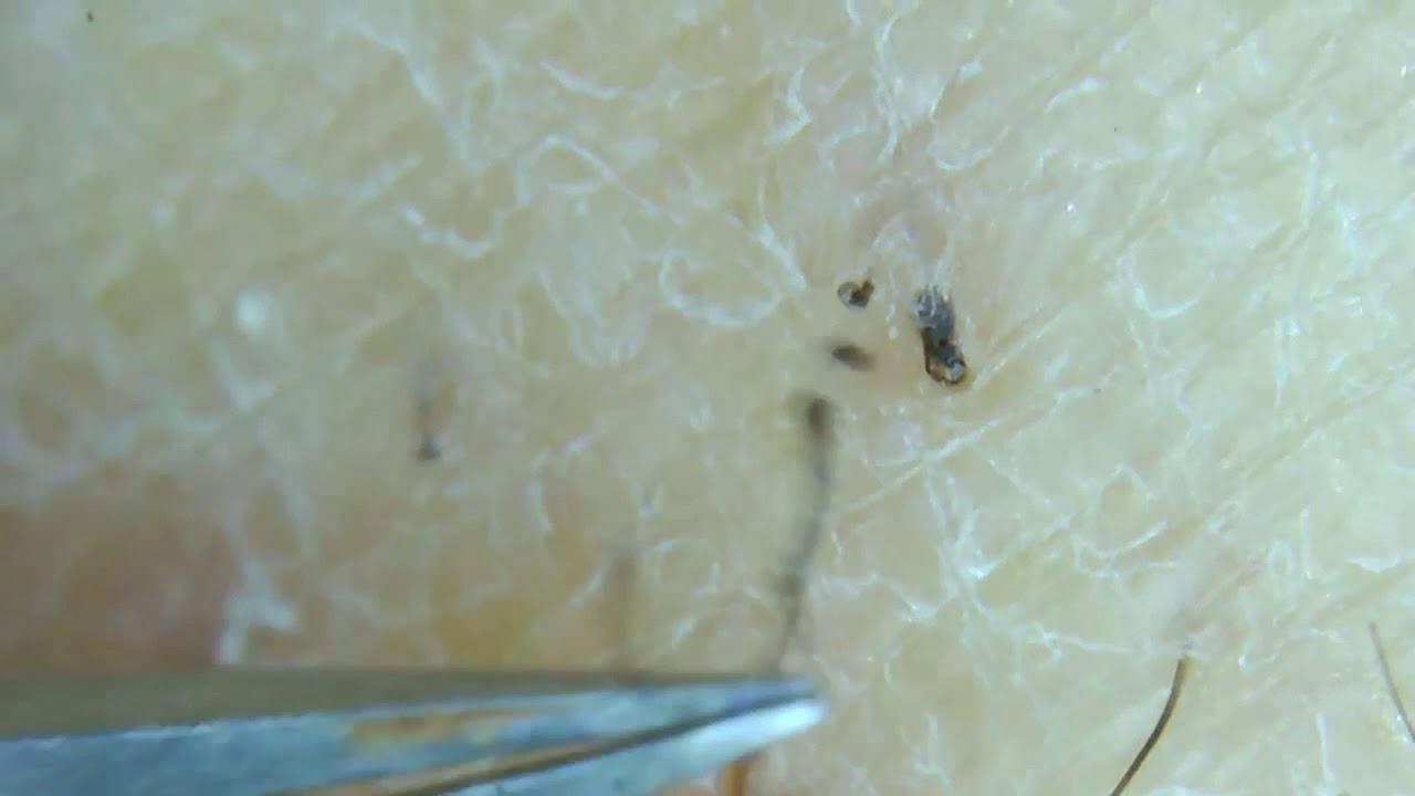 Ingrown Compilation You Must See! - YouTube