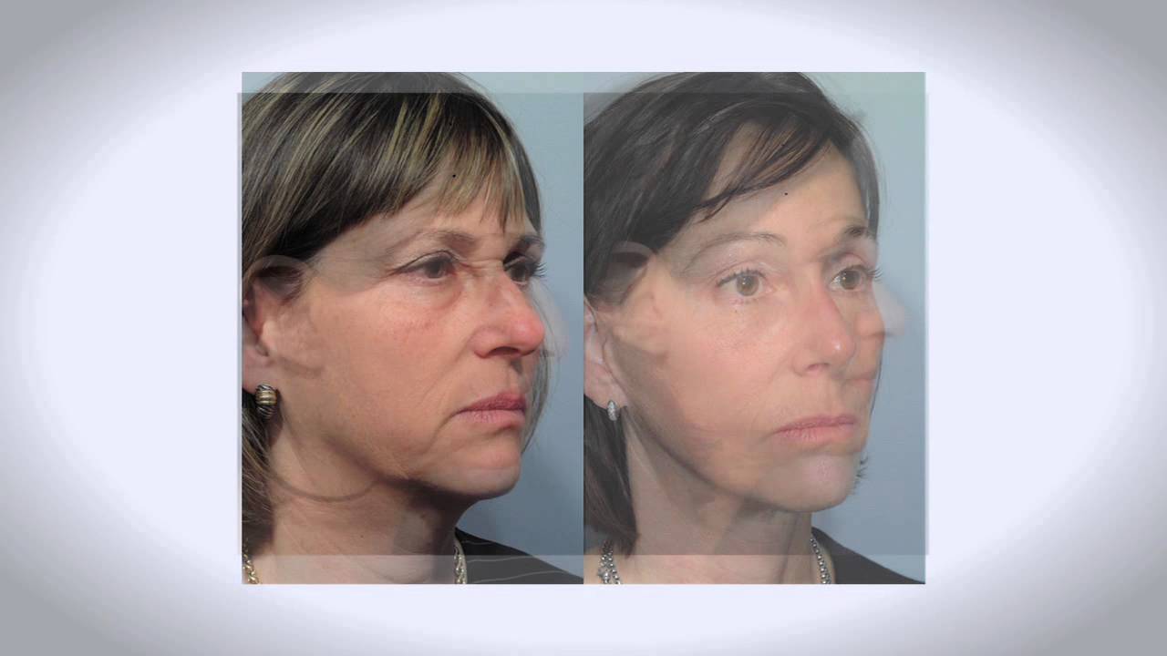 Dr Steven Pearlman New York Plastic Surgeon - YouTube