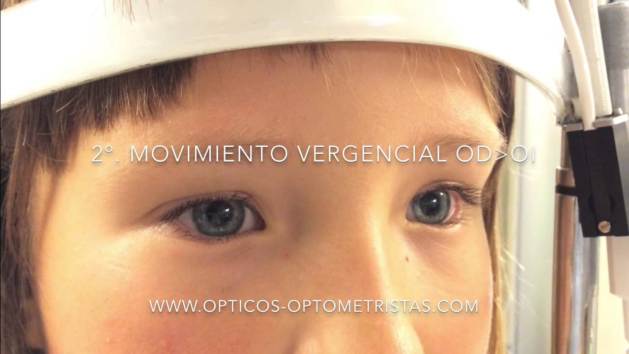 Movimientos oculares en el cover test con exoforia - YouTube