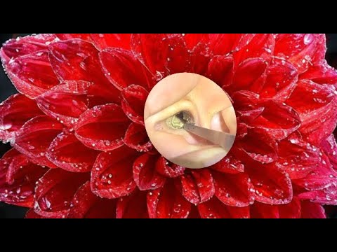 Ear Wax Removal, Dead Skin & Debris Extractio#00072 - YouTube