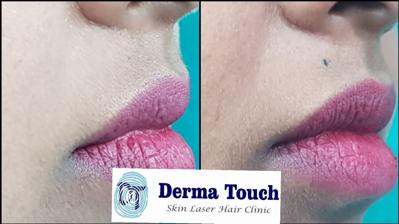 Permanent beauty spot/mole creation on face. - YouTube