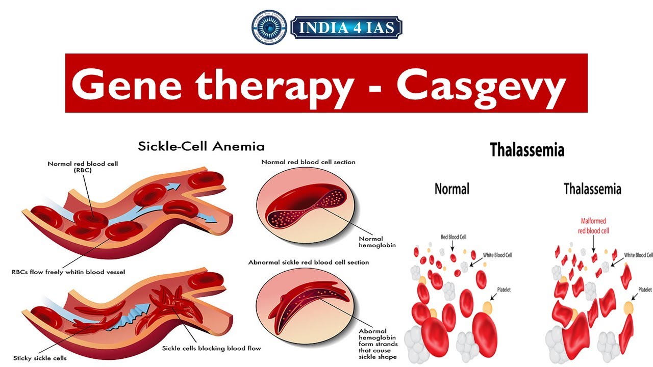 GENE THERAPY - CASGEVY | UPSC GENERAL STUDIES | #india4ias #upsc # ...