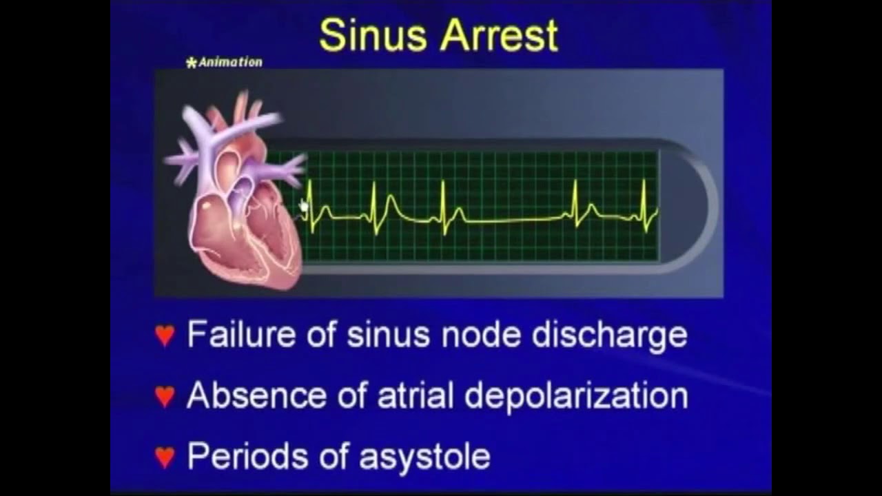 5.1.a. Sinus Arrest - Bradyarrhythmias [Hong Kong University] - YouTube