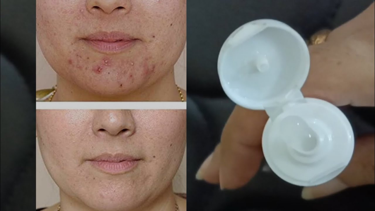 Best remedy for pimples | Acne Treatment | Skincare - YouTube