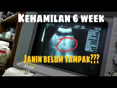 USG 6 week dan 7 week - usg - awal kehamilan - YouTube