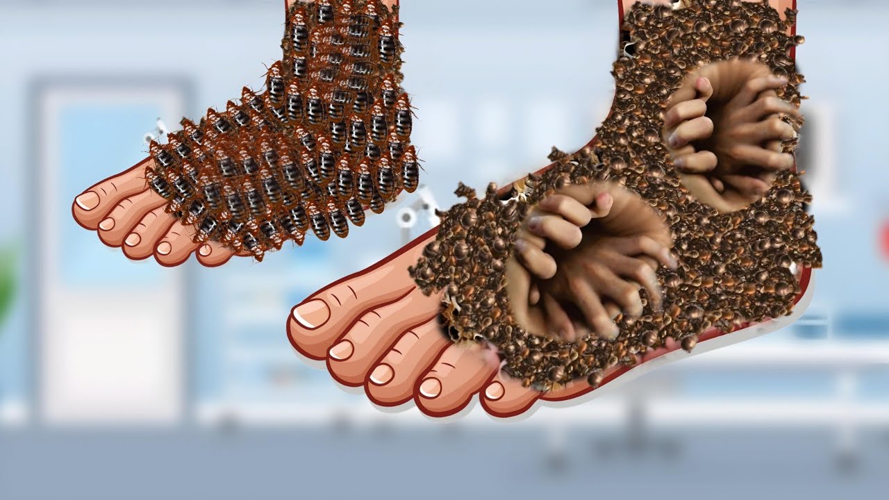 ASMR remove maggots, worms Pustules in the foot leg | ASMR Animation ...