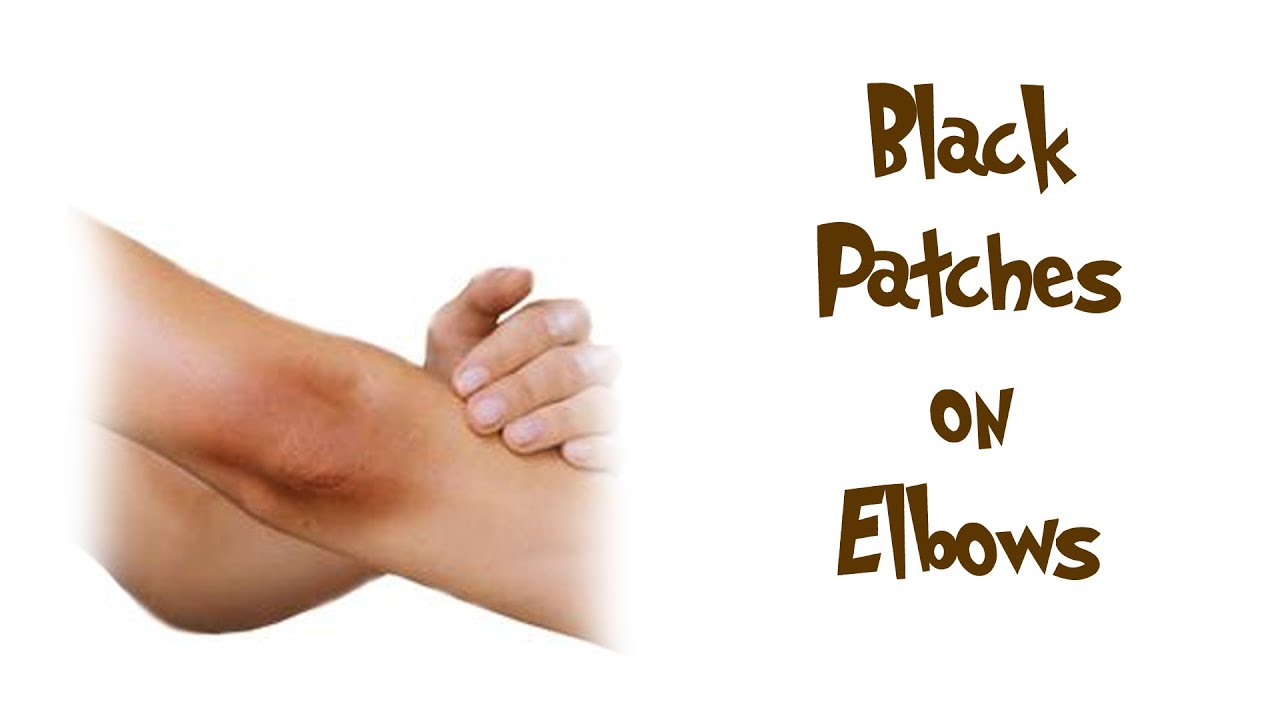 Home Remedy to Remove Black Patches on Elbows - YouTube