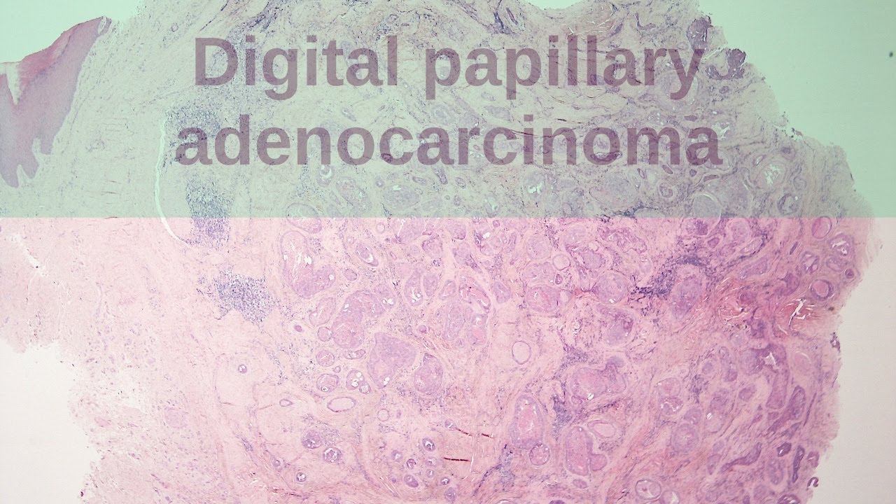 Digital Papillary Adenocarcinoma - Pathology mini tutorials - YouTube