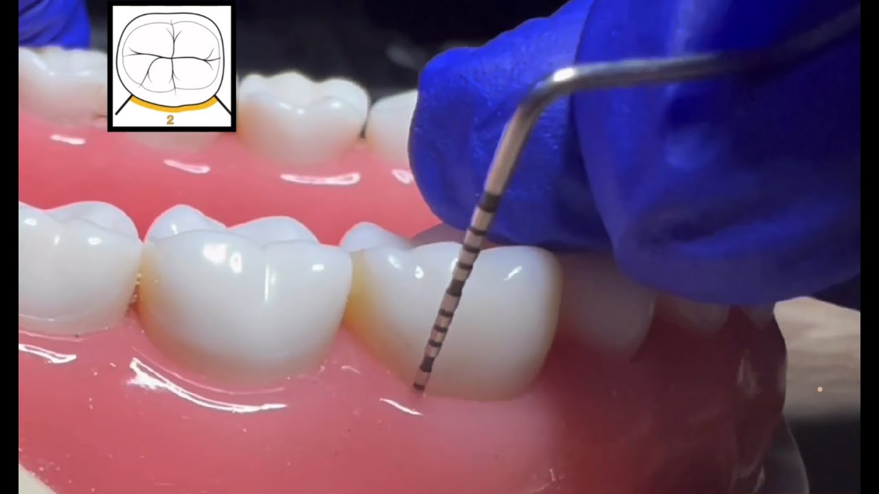 How to use periodontal probe? Periodontal probing technique for ...
