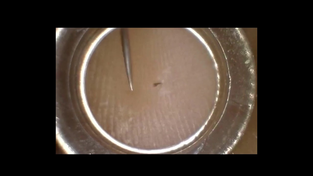 Jumping Splinter In Heel Removal - YouTube