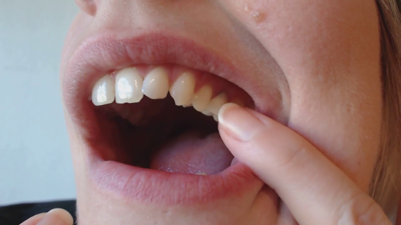 Teeth with Silver Fillings, White Fillings and Crown - YouTube