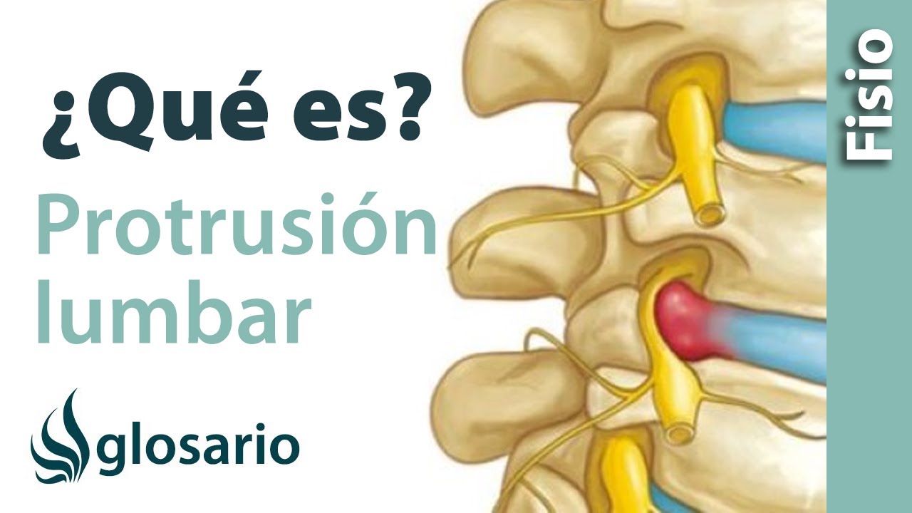 PROTRUSIÓN DISCAL LUMBAR | ¿Qué es? - YouTube