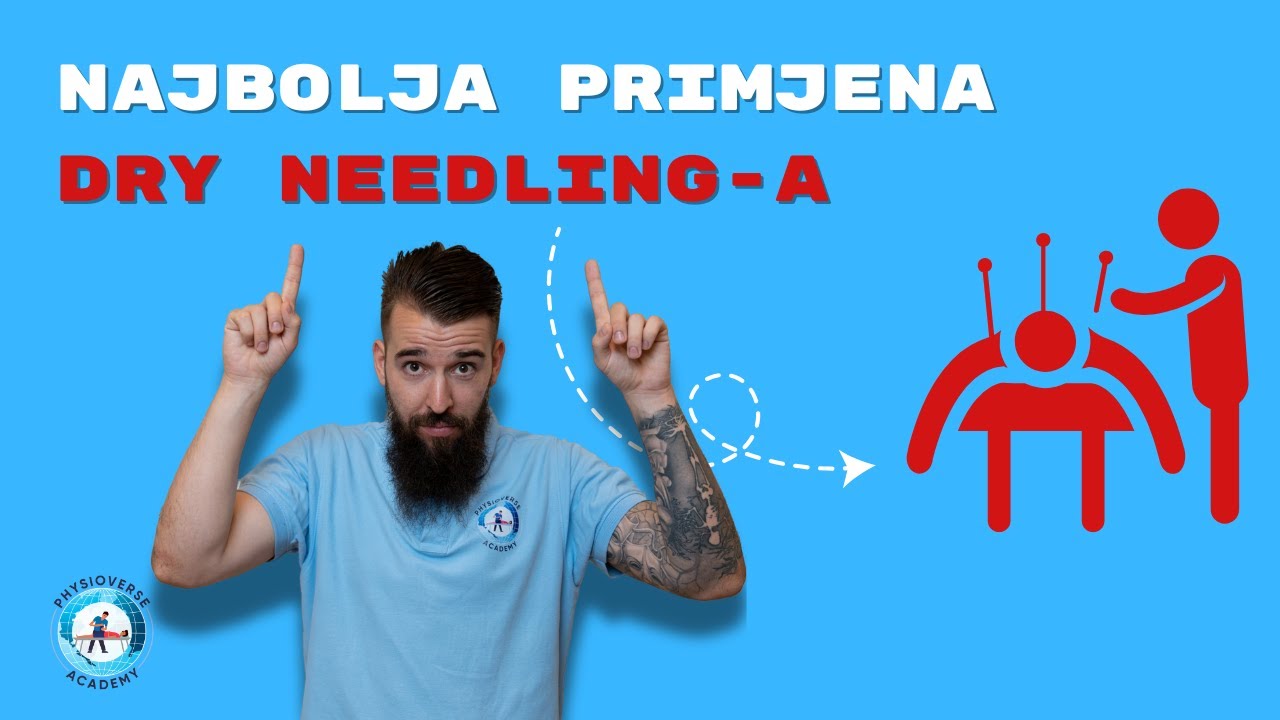 VRSTE primjene Dry needling tehnike | Physioverse Academy - YouTube