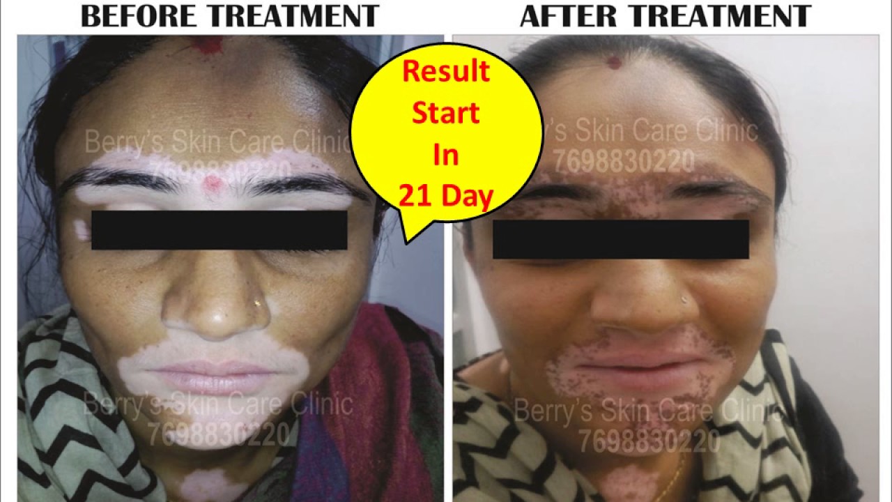 Fastest Recovery in Vitiligo /Leucoderma/White Patch - YouTube