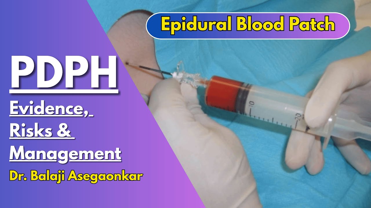 Post Dural Puncture Headache (PDPH) – Evidence, Risks & Management | Dr ...