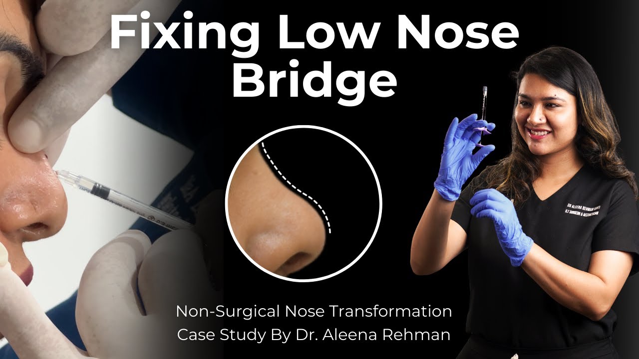 Low Nose Bridge Transformation with Non Surgical Rhinoplasty . - YouTube