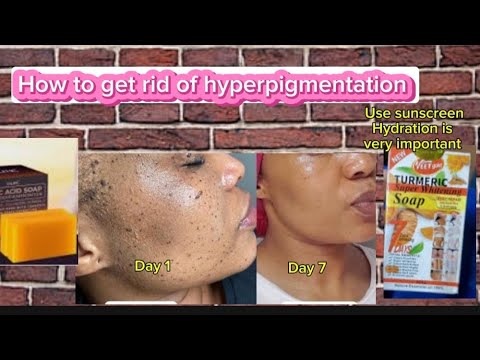 How to get rid of hyperpigmentation in 7days. - YouTube