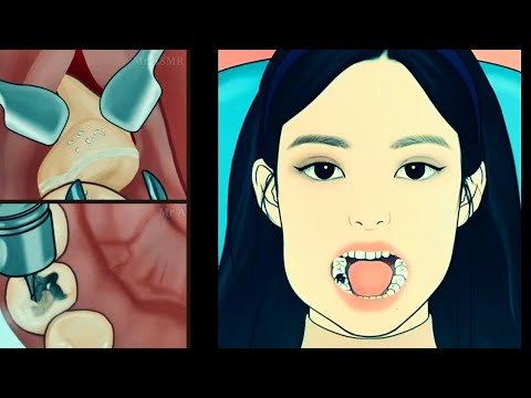 ASMR wisdom Teeth & Cavity Treatment Animation / ASMR animation #asmr # ...