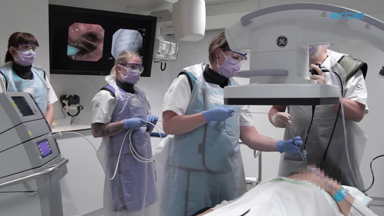 Transbronchial cryobiopsy with single-use cryoprobe - YouTube