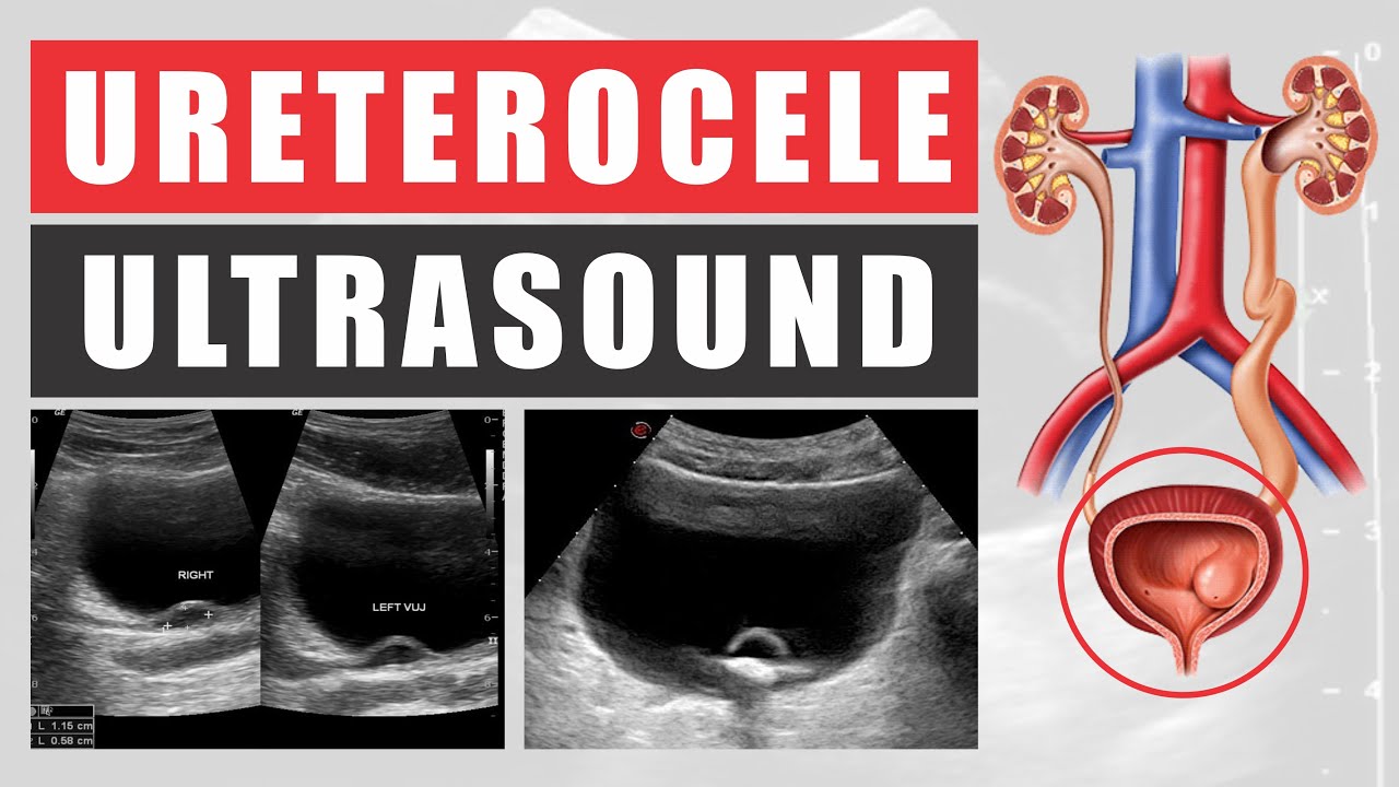 Ureterocele and Ultrasound - YouTube