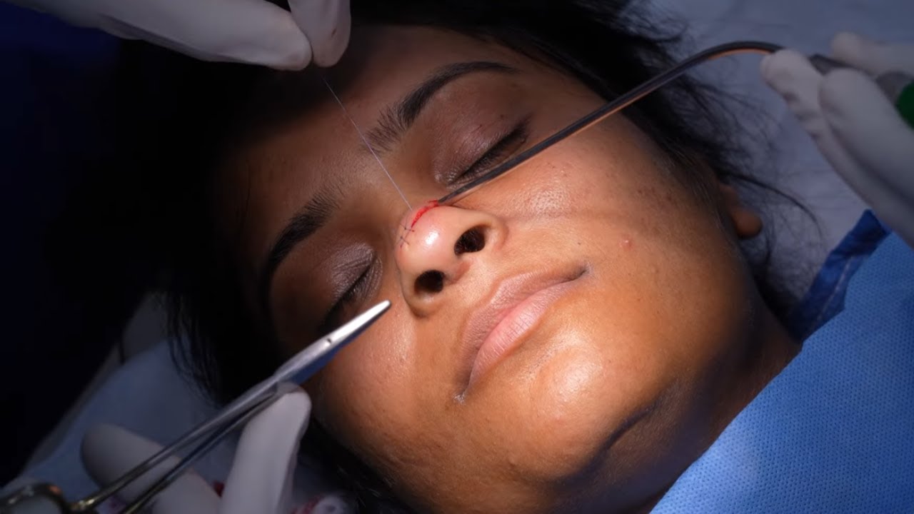 Successful Nose Scar Revision: Erase the Past - YouTube