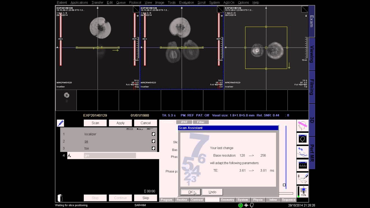 MRI scanner operation ( gradient noise recorded) 磁振造影的操作過程及儀器所發出的噪音 ...