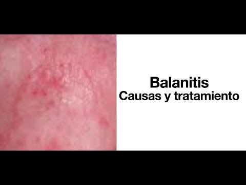 Balanitis: Causas y tratamiento - Cura de la balanitis
