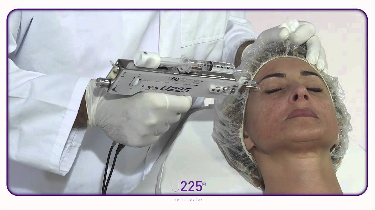 The Vampire Lift and Hair Restoration - YouTube