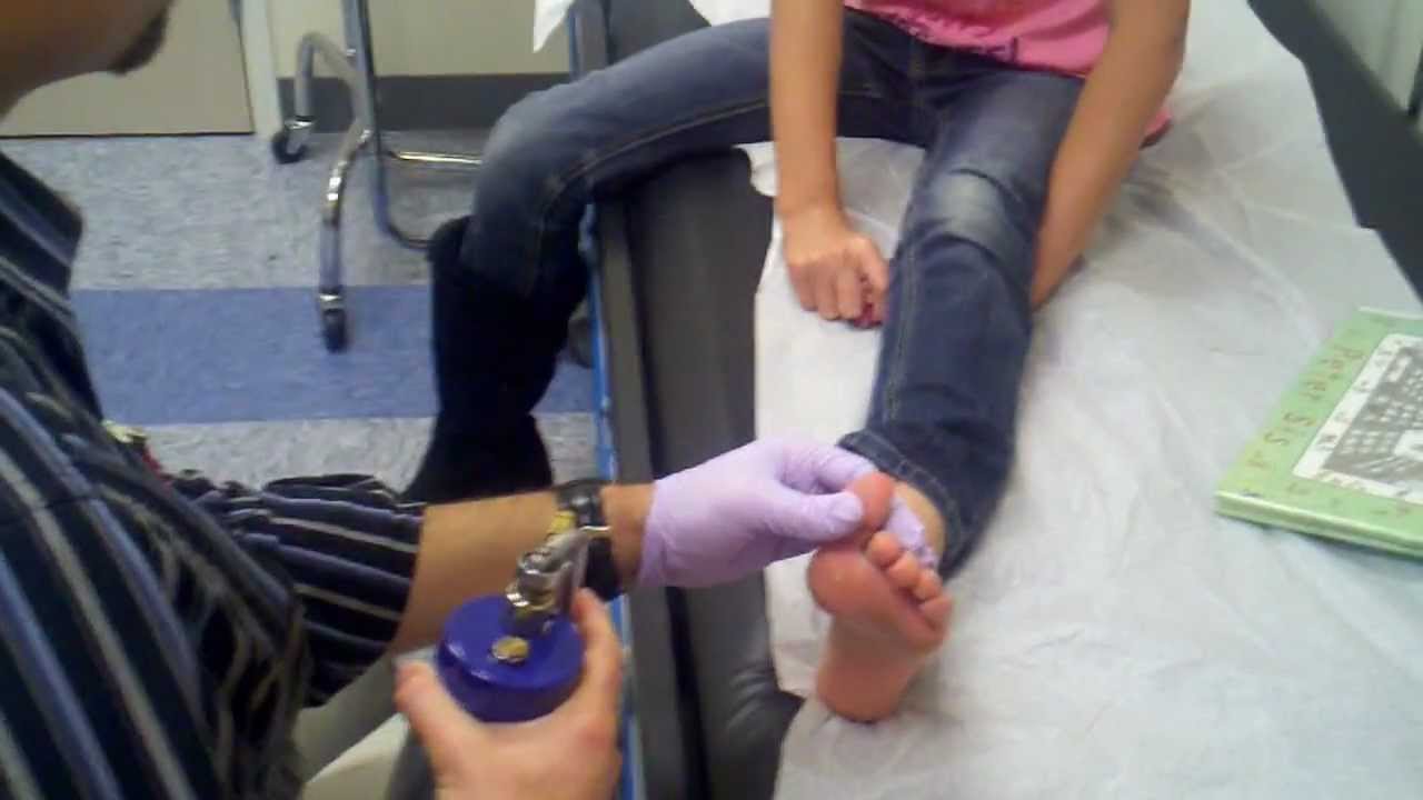 Getting wart frozen off - YouTube