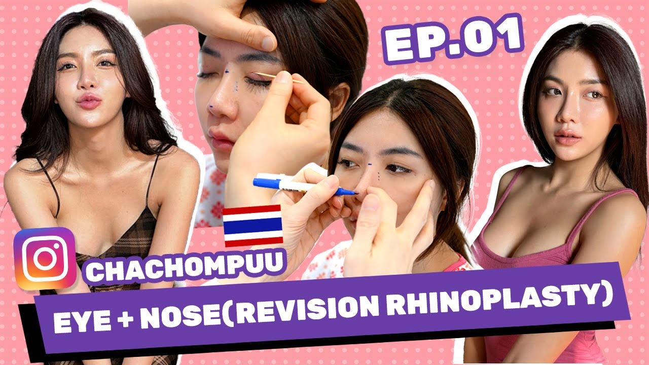 [Plastic Surgery Korea] ไปศัลยกรรมเกาหลีคนเดียว‼️ ทำตาสองชั้น+แก้จมูก | Chachompuu Ep.1 - YouTube