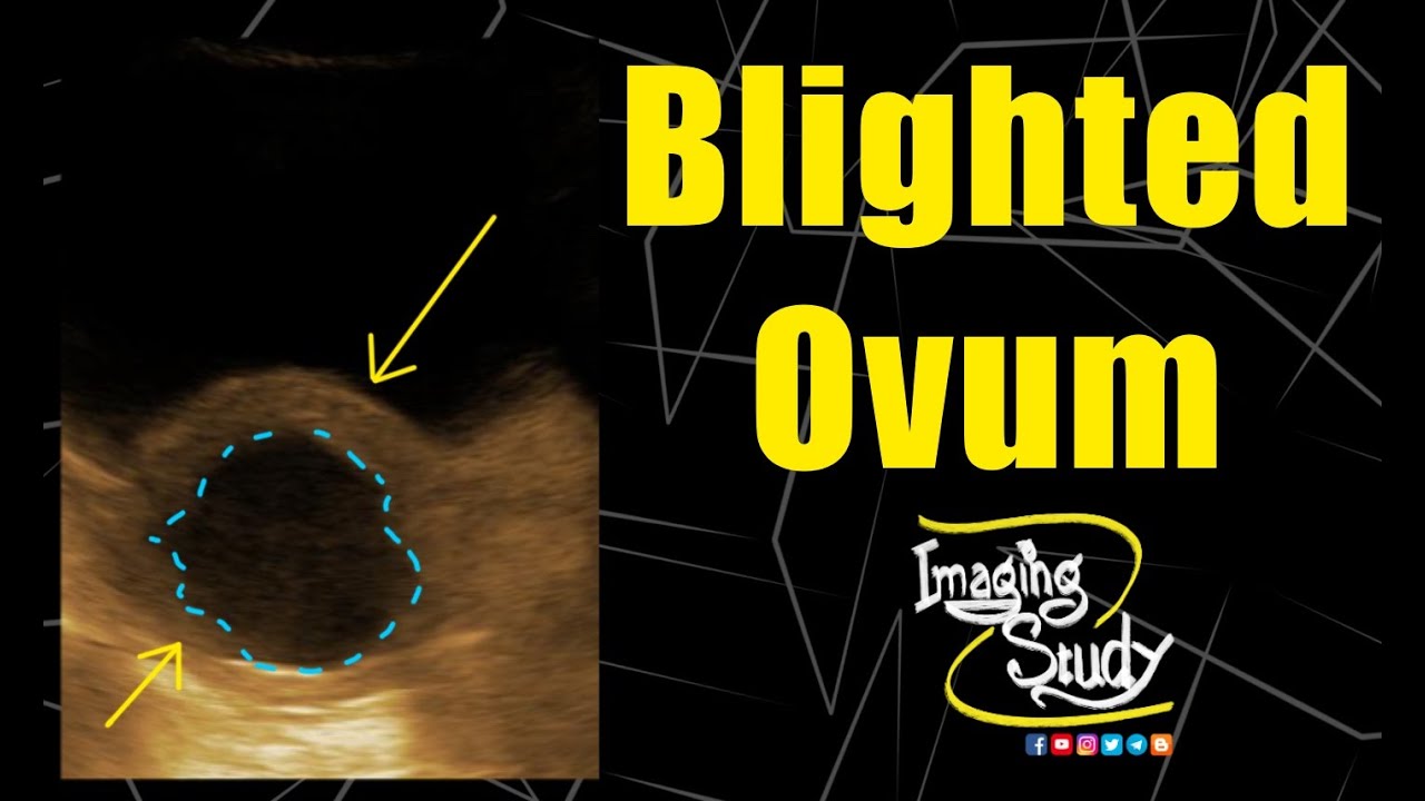 Blighted Ovum || Ultrasound || Case 147 - YouTube