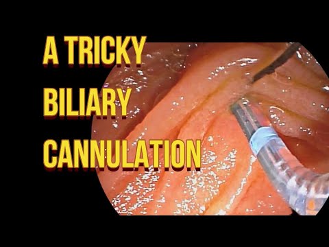 A Tricky Bile Duct Cannulation - #ERCP Skills - YouTube
