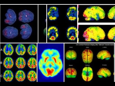 What Causes Psychogenic Non-Epileptic Seizures (PNES/NEAD) and How You ...
