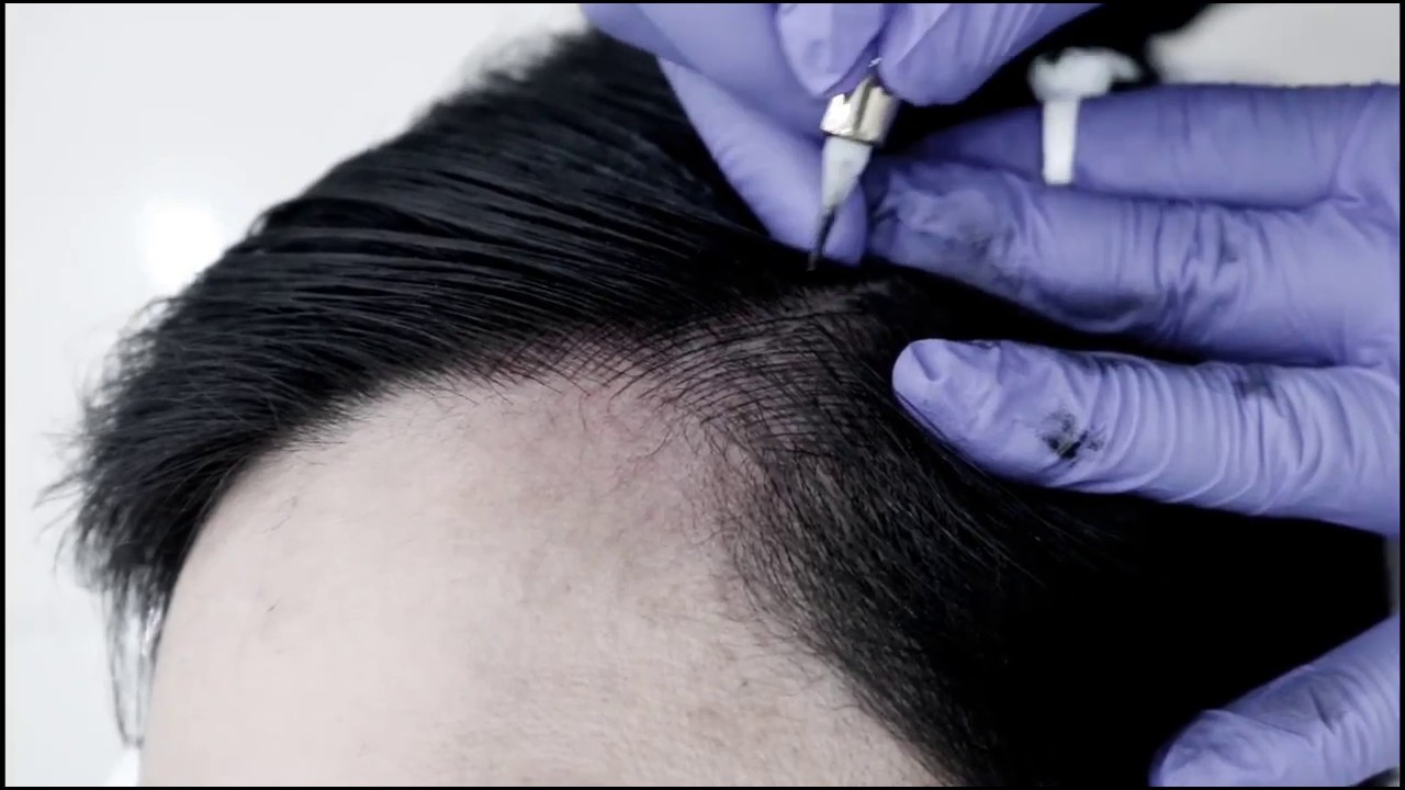 Permasalahan Rambut Yang Tipis, Teknik Sulam Rambut Menjadi Solusi ...