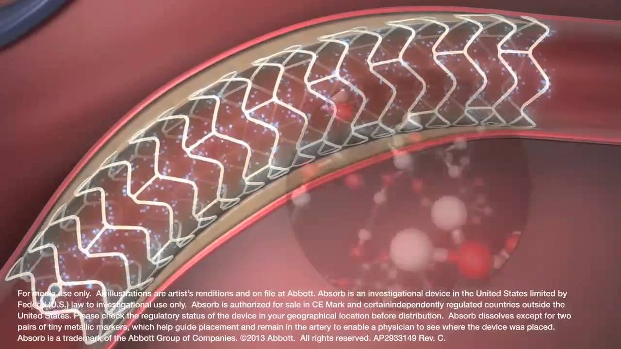 Oplosbare stent van Abbott Animation - YouTube