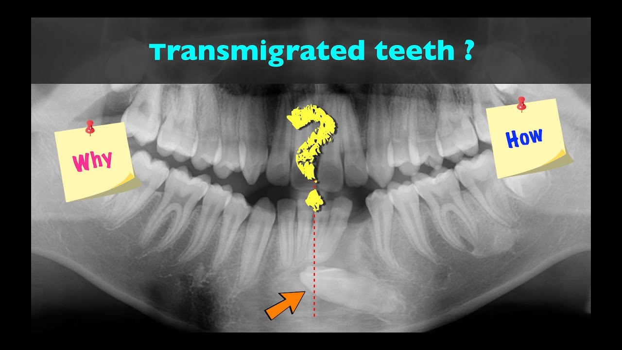Transmigrated teeth｜【Chris Chang Ortho】CC741 - YouTube