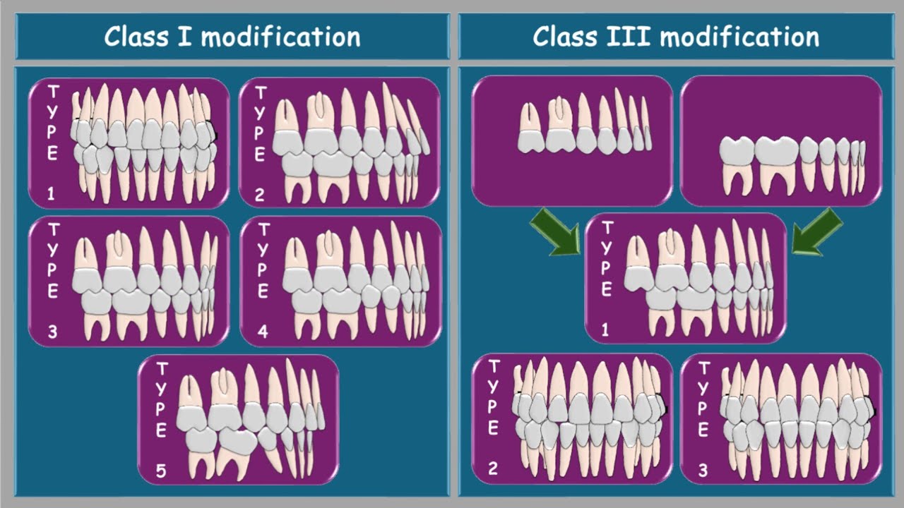 Dewey Classification of Malocclusion Animation - YouTube