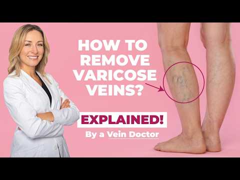 How to Remove Varicose Veins? A Vein Doctor Explains!
