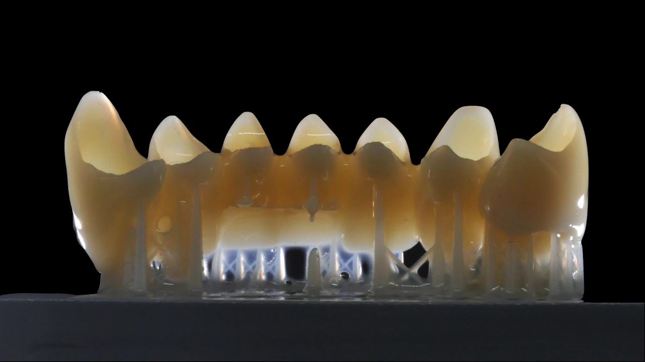 7 units lower restoration - Part 4: ultra speed Chairside printing by ...