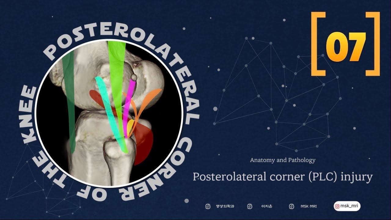 [PCL 07] #2 Popliteus musculotendinous complex, popliteomeniscal ...