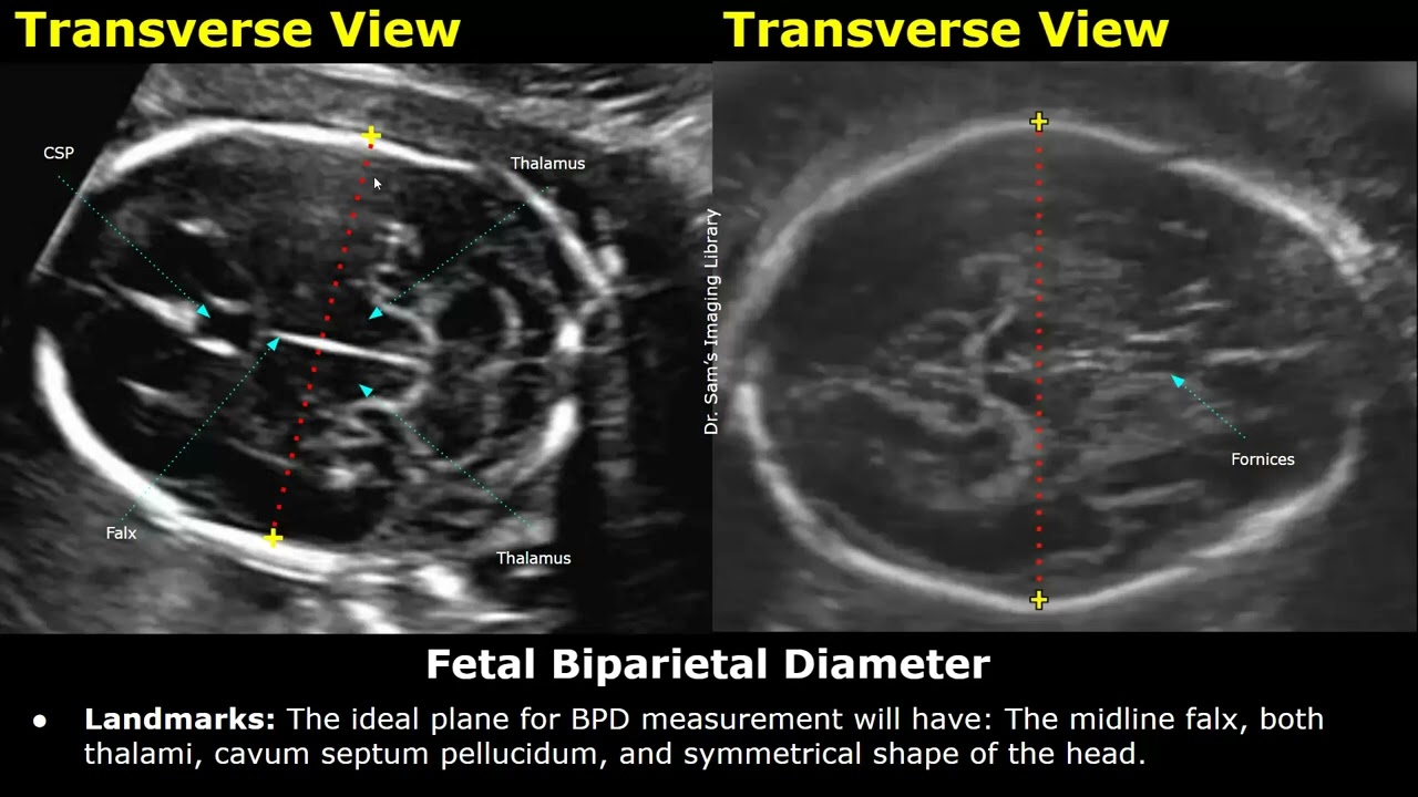 How To Measure Fetal Biparietal Diameter On Ultrasound BPD How To Measure Fetal Biparietal Diameter On Ultrasound BPD