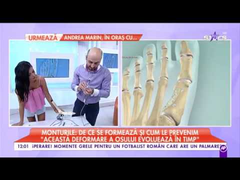 Operatia de monturi ( hallux valgus ) Dr Tatarek Nazer - YouTube