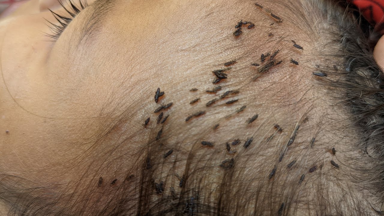 Getting out all hundred lice from head - Remove all big lice from hair ...