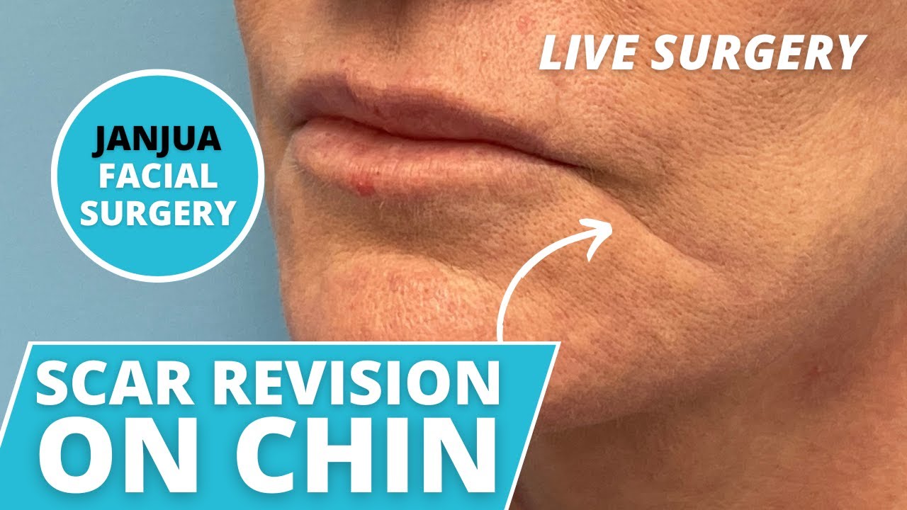 SURGICAL SCAR REVISION ON CHIN (LIVE SURGERY) - DR. TANVEER JANJUA ...