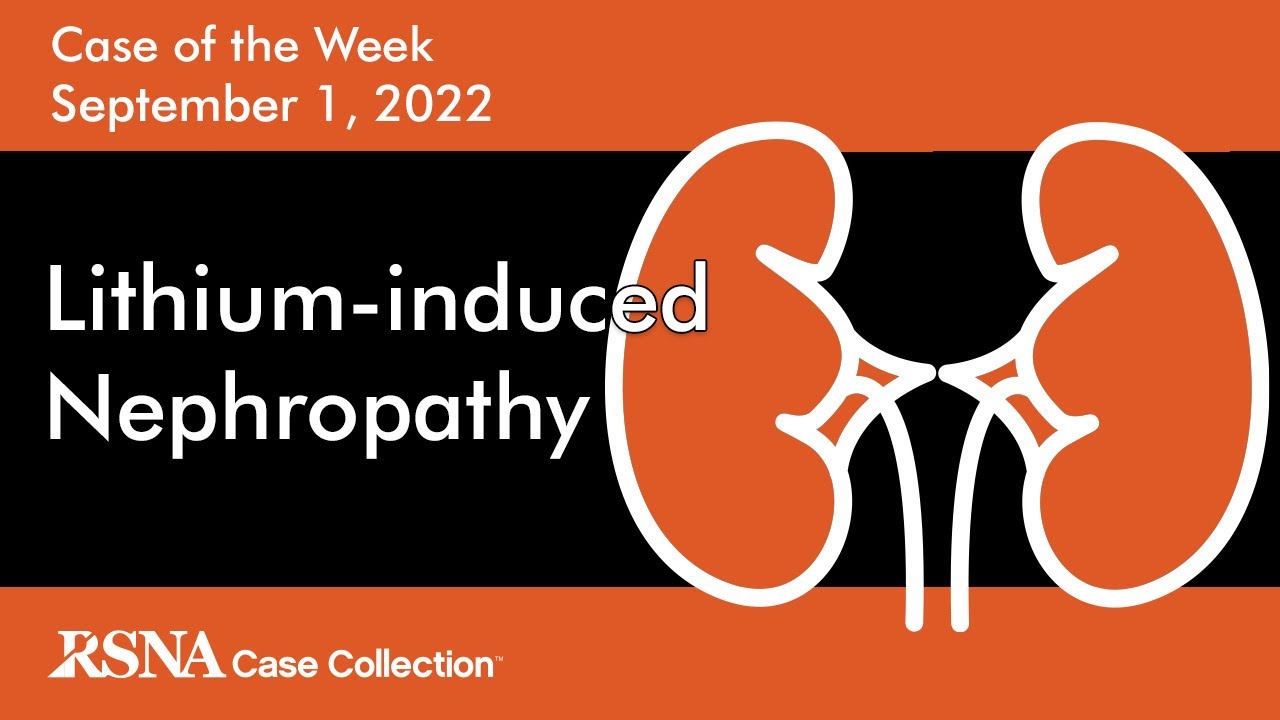 Case of the Week: Lithium-induced Nephropathy - YouTube