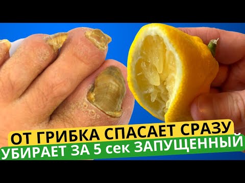 Dırnaq Göbələyi 5 Saniyədə Əbədi Yox Olacaq, Bu Metod Yardım Edəcək! Dırnaq göbələklərinin müalicəs