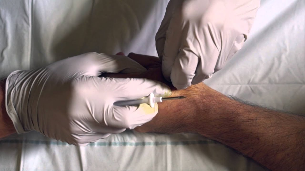 xNT Tag Implant - YouTube