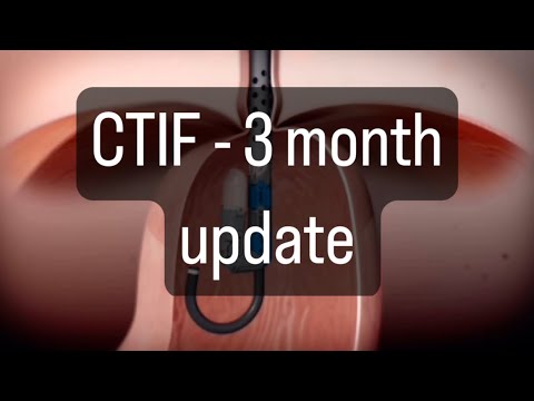 cTIF surgery for heartburn / gerd - 3 month update & review - YouTube