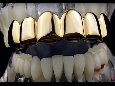 14k Gold Plated Slugs Six Upper Teeth Grillz - YouTube